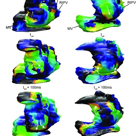 Examples Of Left Atrial Flutter Sustained By Perimitral Reentry