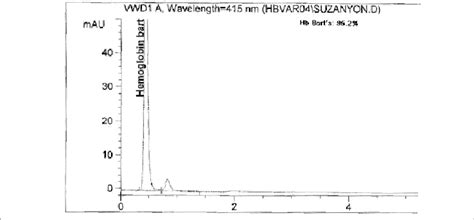 Hemoglobin Electrophoresis Of The Patient Showing High Hb Barts