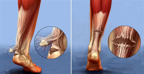 Plantaris Muscle Rupture