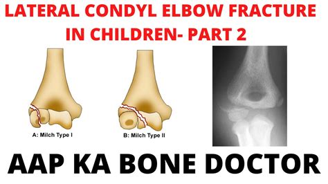 Lateral Condyle Elbow