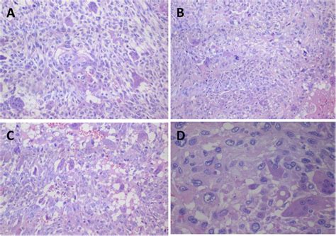 Undifferentiated Pleomorphic Sarcoma Undifferentiated Pleomorphic