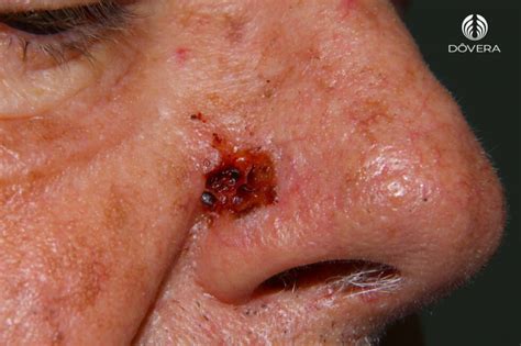 Carcinoma Basocelular Micronodular Diagnóstico E Tratamento