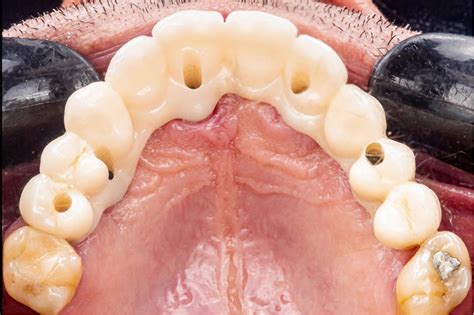 Full Mouth Occlusion Reconstruction Implant Case