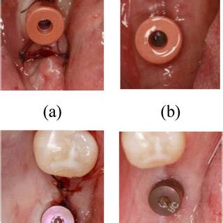Peek Abutments A Peek Healing Abutment Gm Customizable Healing