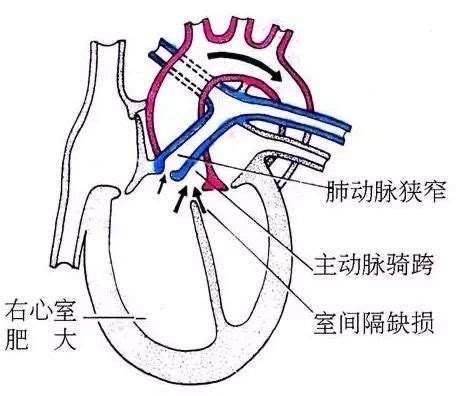 法洛四联症百度百科 法洛四联症百度百科