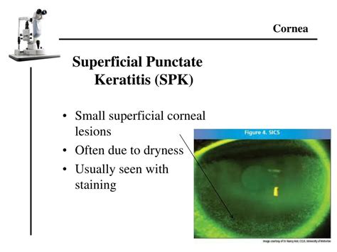 Ppt Slit Lamp Exam Findings Powerpoint Presentation Free Download Id 4737512