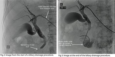 Percutaneous Transhepatic Biliary Drainage Ptbd