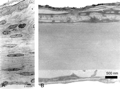 Electronmicrograph Of A Normal Pars Flaccida And B Normal Pars Tensa