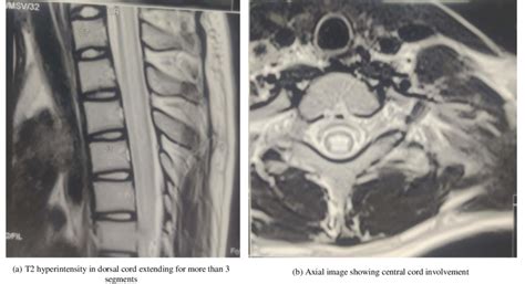 [patient 28] Acute Myelitis Mri Spine Showing Download Scientific