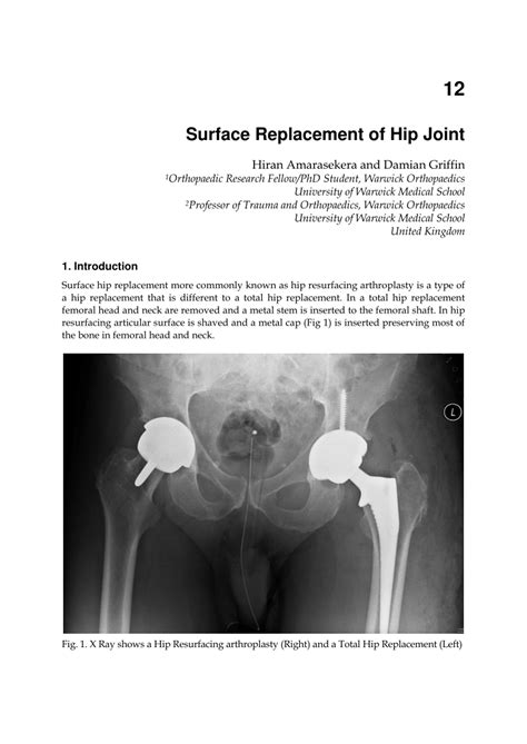 Pdf Surface Replacement Of Hip Joint