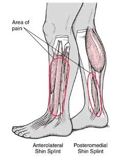 Muscles Medial Tibial Stress Syndrome