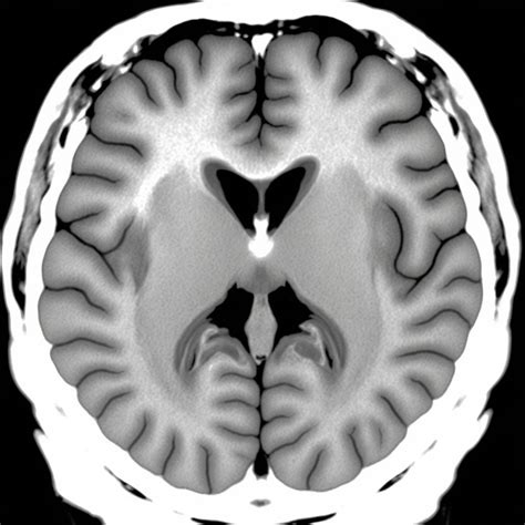 Grayscale Brain Mri Slice Stable Diffusion Online