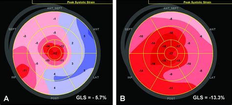 Role Of Advanced Left Ventricular Imaging In Adults With Aortic