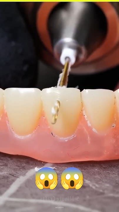 From Normal To Royal Gold Teeth Upgrade Banglafacts Shorts