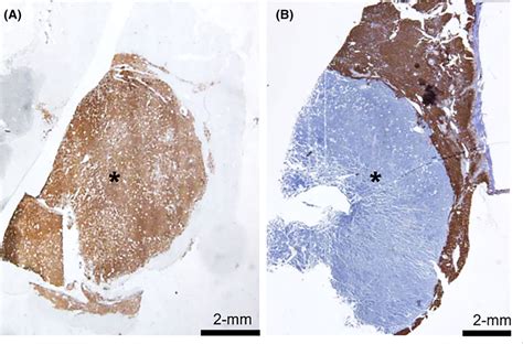 Immunohistochemical Detection Of Synaptophysin And 3beta‐hydroxysteroid