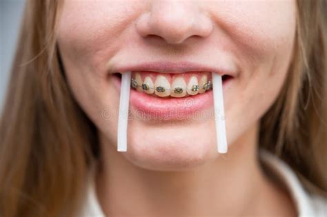 Close Up Portrait Of A Woman With Braces Using Special Orthodontic Wax Girl Fooling Around