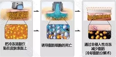 冷冻溶脂能代替吸脂手术吗？与传统吸脂有什么不同？ 非常爱美