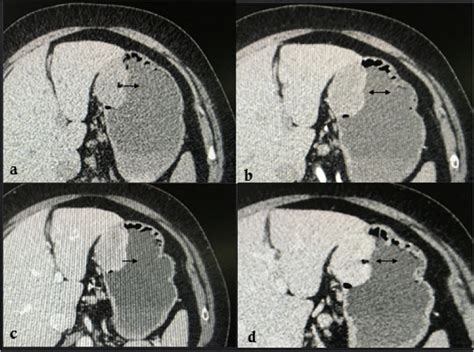 A Non Contrast Ct Scan Shows Well Defined Homogeneous Download