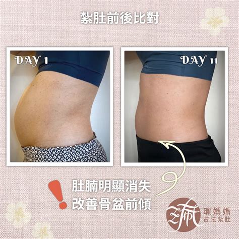 珮媽媽古法紮肚 【珮媽媽古法紮肚 前後比對】 11日療程，第二胎剖腹，產後5個月 Winnie