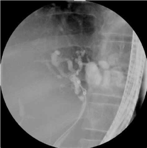 Ercp Of A Uc Patient With Psc Showing High Grade Strictures Within The