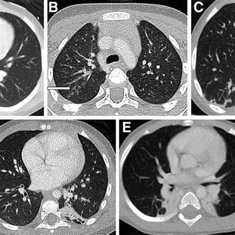 Trends In Atelectasis Scoring The Annotated P Chart Displays The