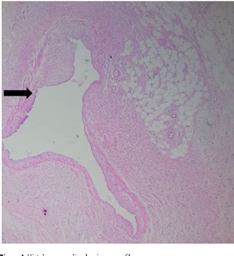 [pdf] Giant Scalp Plexiform Neurofibroma Associated With Nf 1 Semantic Scholar