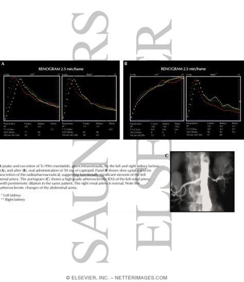 Captopril Renogram