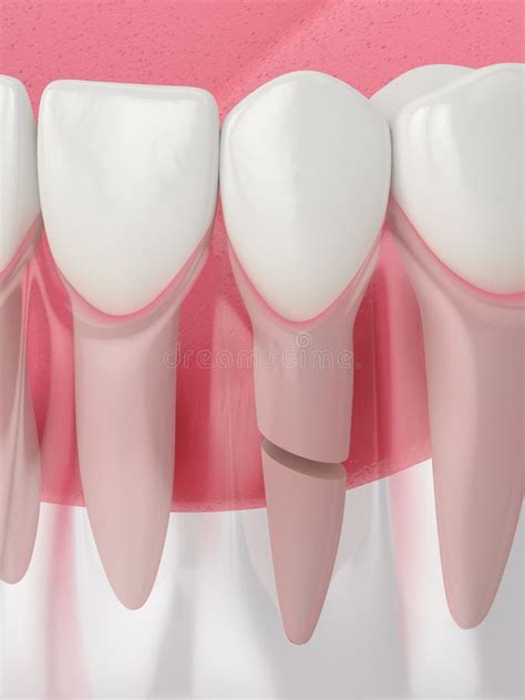 3d Render Of Jaw With Cracked Tooth Root Stock Illustration