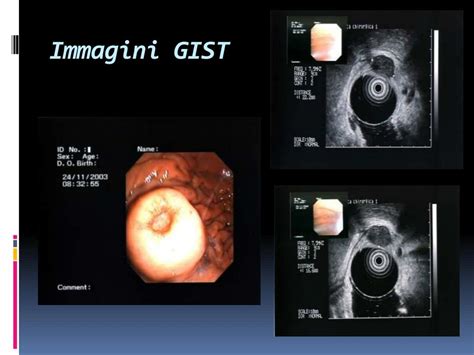 Ppt Gistdiagnosi Endoscopica Powerpoint Presentation Free Download