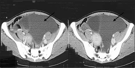 Axial Image Of Contrast‐enhanced Computed Tomography Cect Of Download Scientific Diagram