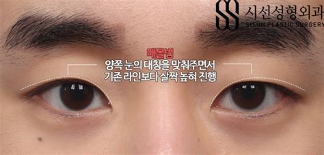 자연스러운 남자 쌍꺼풀 수술 5개월차 후기 네이버 블로그