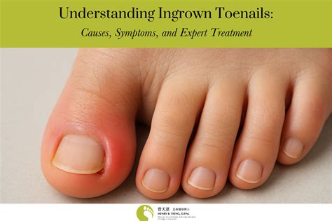 Understanding Ingrown Toenails Causes Symptoms And Expert Treatment