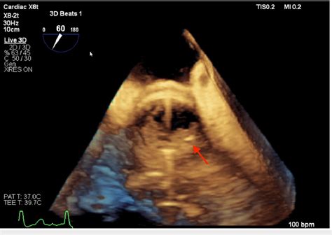 Tee Showing Perivalvular Abscess On An Aortic Prosthetic Valve Arrow Download Scientific