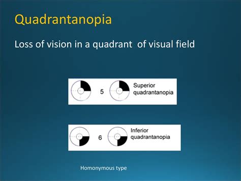 Visual Pathway Lesions Ppt Download