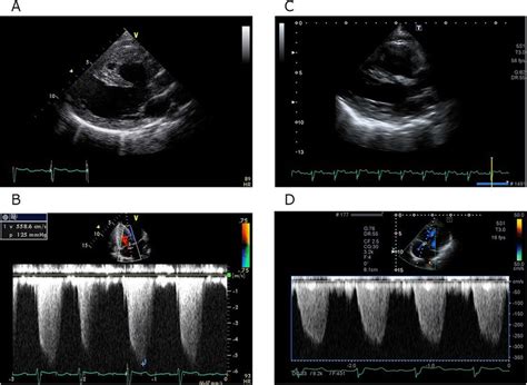Transthoracic Echocardiography A Perimembranous Type Vsd In The Download Scientific Diagram