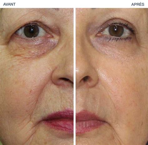 Plexr® à Paris Traitement Des Paupières Des Rides Et Des Imperfections Cutanées