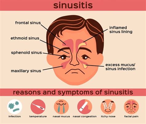 A Comprehensive Guide To Understanding Sinusitis Goelentcare