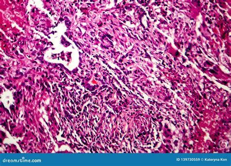 Miliary Tuberculosis Light Micrograph Stock Image Image Of Stain