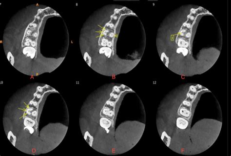 Cone Beam Computed Tomography Cbct Analysis Of An Unusual