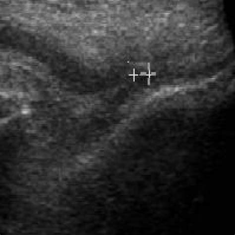 Parotid Duct Stone Ultrasound