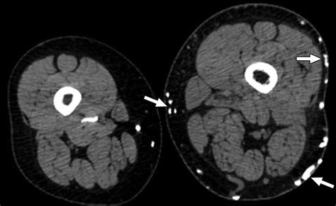 Direct Ct Venography For Evaluation Of The Lower Extremity Venous