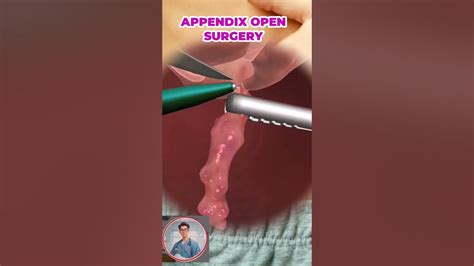 Infected Apendix Removal With Open Surgery Doctor Surgeryeducation