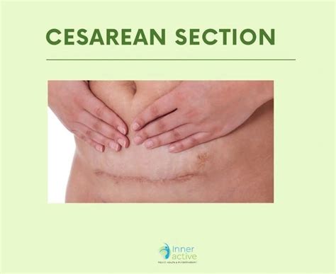 Csectionawarenessmonth Postnatalrecovery Womenshealthphysio