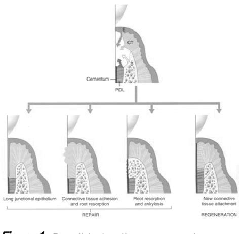 Figure 1 From Guided Tissue Regeneration Using Resorbable Membrane With