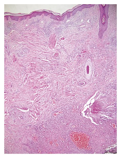 Dissecting Cellulitis Of The Scalp A Inflamed Granulation Tissue And