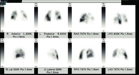 Ventilation Perfusion Scan Of Patient With Thromboembolic Pulmonary Download Scientific Diagram