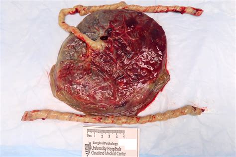 Pathology Outlines Grossing Pathology Outlines Grossing