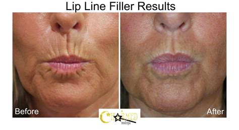 The Ultimate Guide To Treating Lip Lines With The Newest Skin Glaze