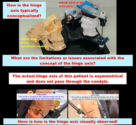 The Problem Of The Hinge Axis Concept
