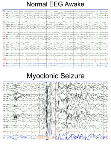 Juvenile Myoclonic Epilepsy Janzs Syndrome Symptoms And Treatment